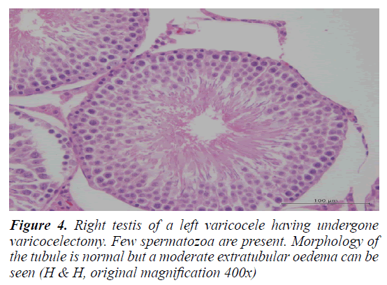 Does Left Varicocele Impair Right Testic | Biomedical Research